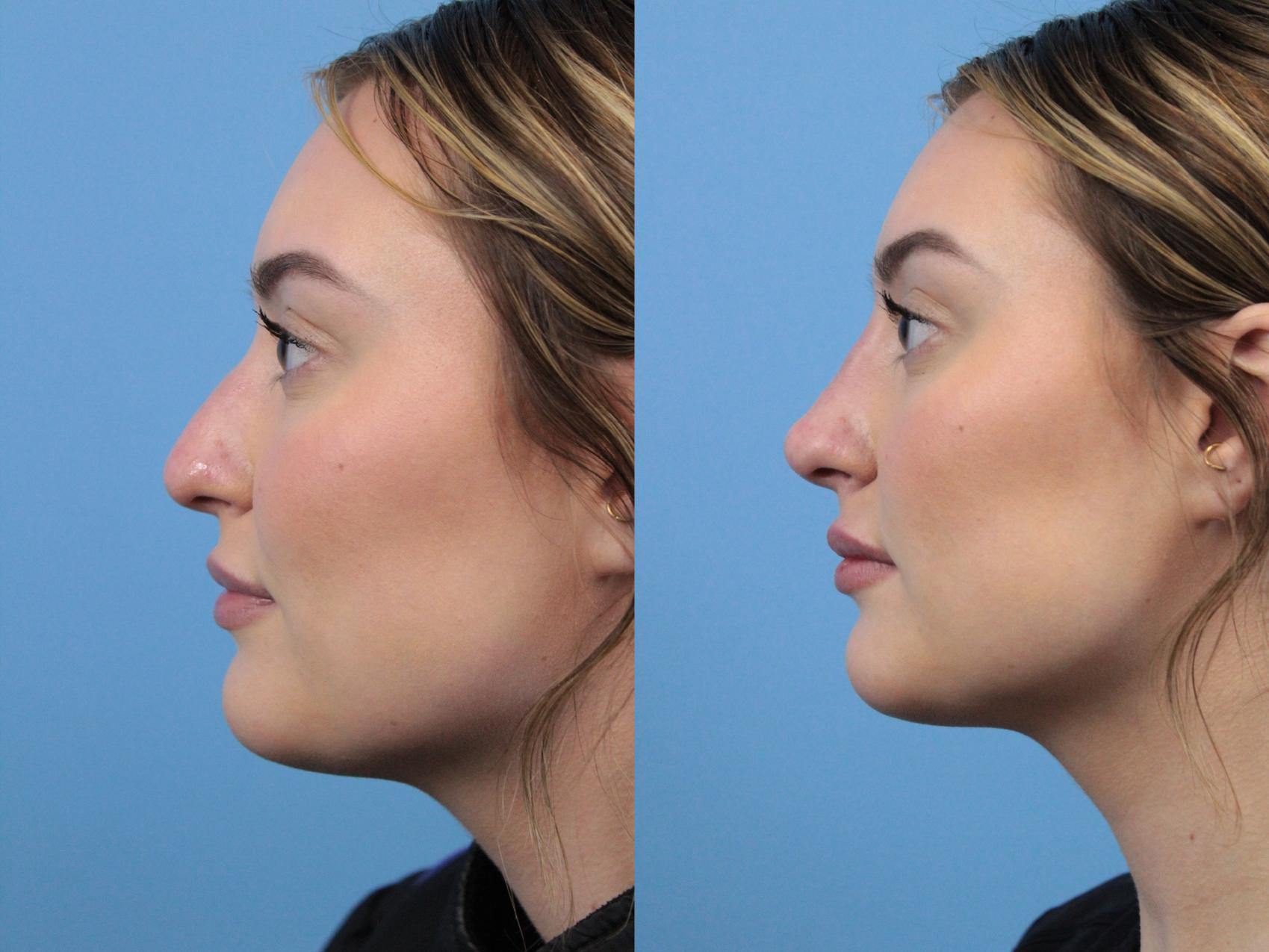 Non Surgical Rhinoplasty Before And After Pictures Case 252 West Des